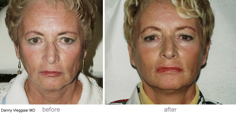 Liquid Face Lift Before And After