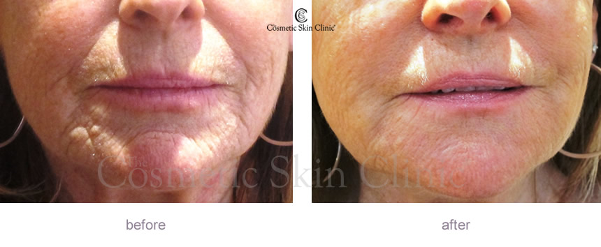 Restylane Skinbooster