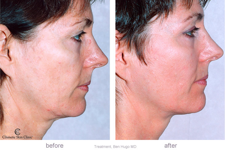 Thermage radiofrequency skin tightening : Before & after gallery