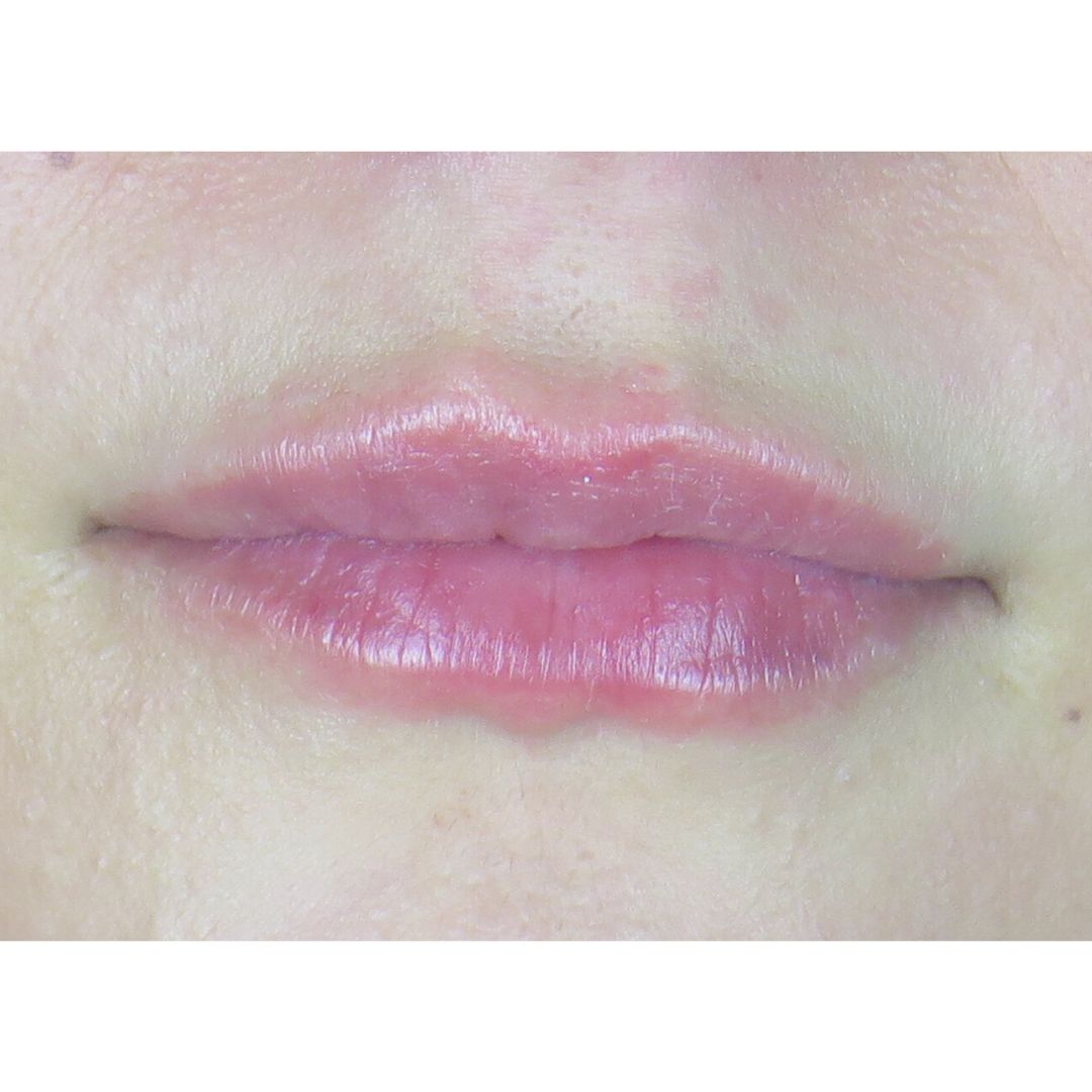 Lip Fillers in London & Buckinghamshire | The Cosmetic Skin Clinic