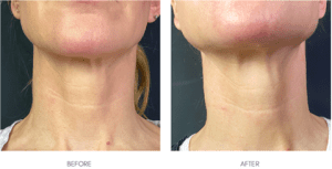 BBL SkinTyte with Profhilo for the neck | Profhilo Wrinkly Neck ...