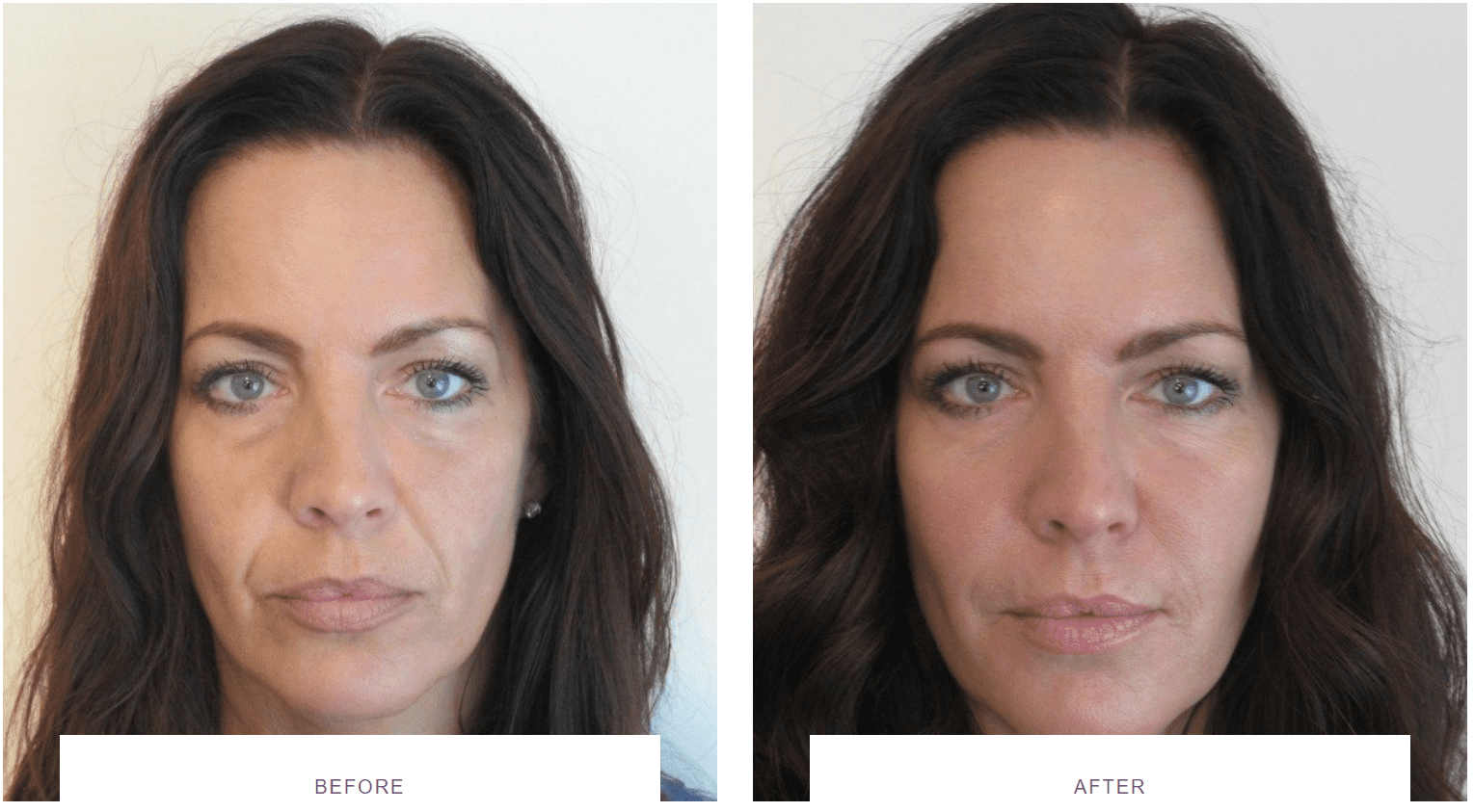 Botox Buckinghamshire - Botox Near Ascot, Beaconsfield, Marlow, High ...