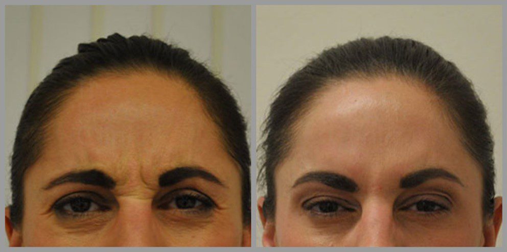 BOTOX AROUND EYES - Botox Eyes Before and After Results, Botox Eyes ...