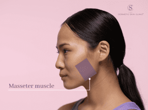 Masseter Botox: How to treat teeth grinding with Botox and reduce a ...