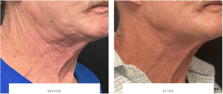 Morpheus8 Pre-Treatment and Aftercare Tips - All you need to know ...