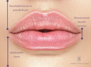 The Best Way to Fix Downturned Mouth Corners | Filler, Botox for ...