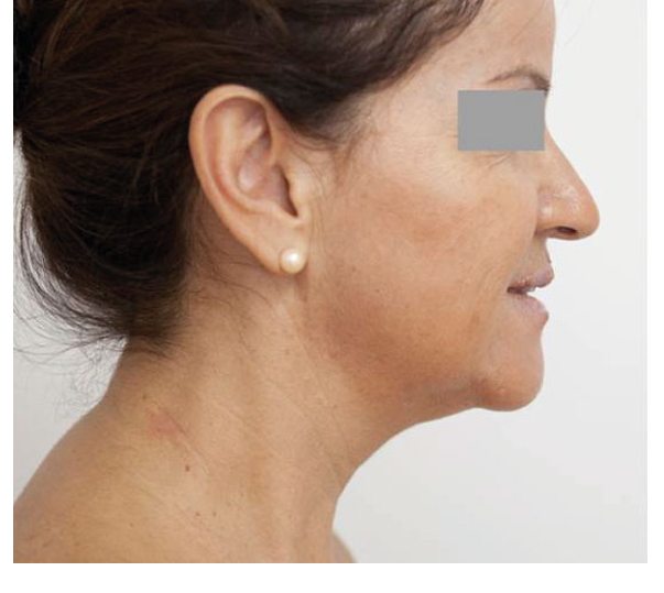 Profhilo Treatment London, Profhilo Body London | Profhilo ...