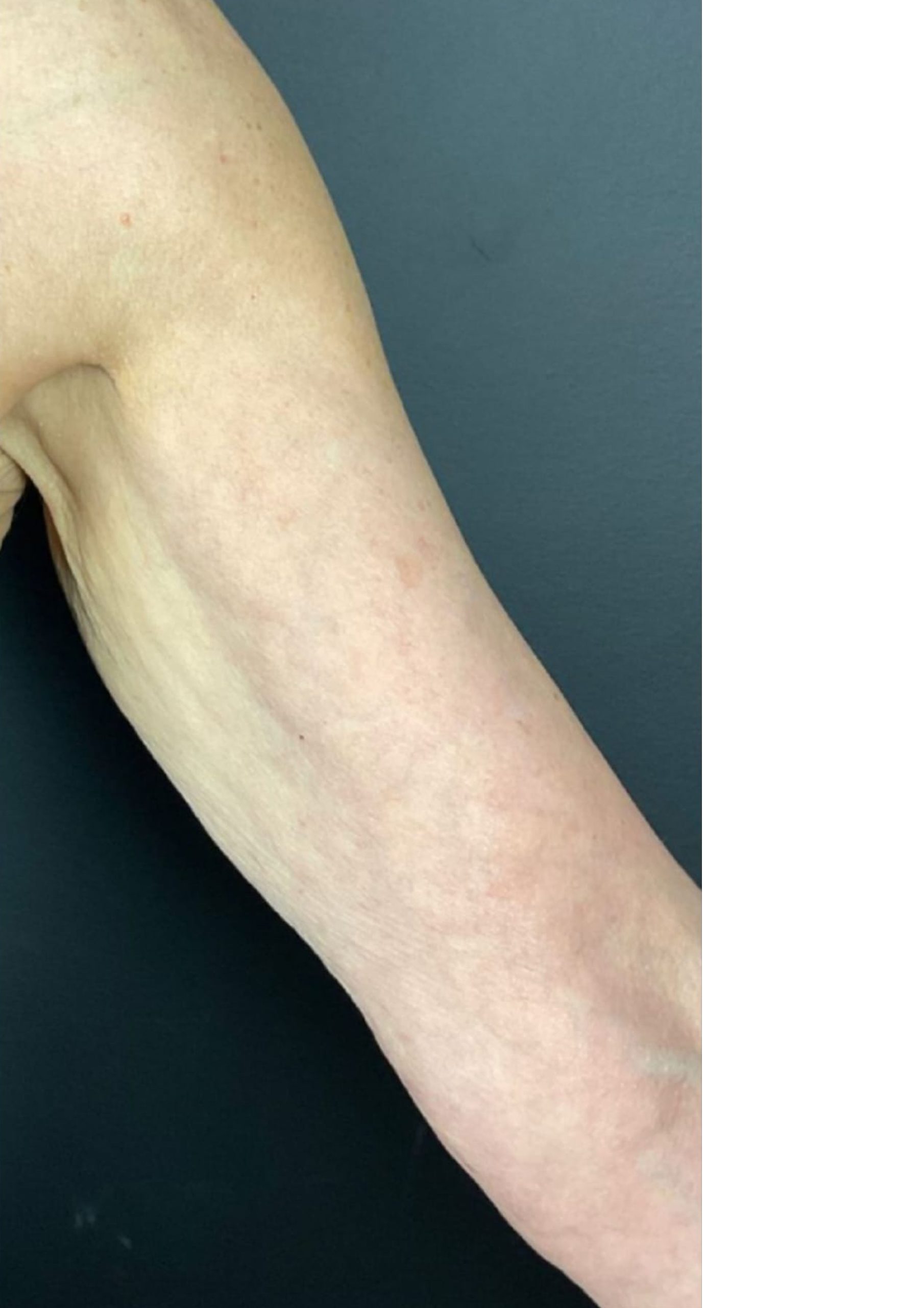 Profhilo Treatment London, Profhilo Body London | Profhilo ...