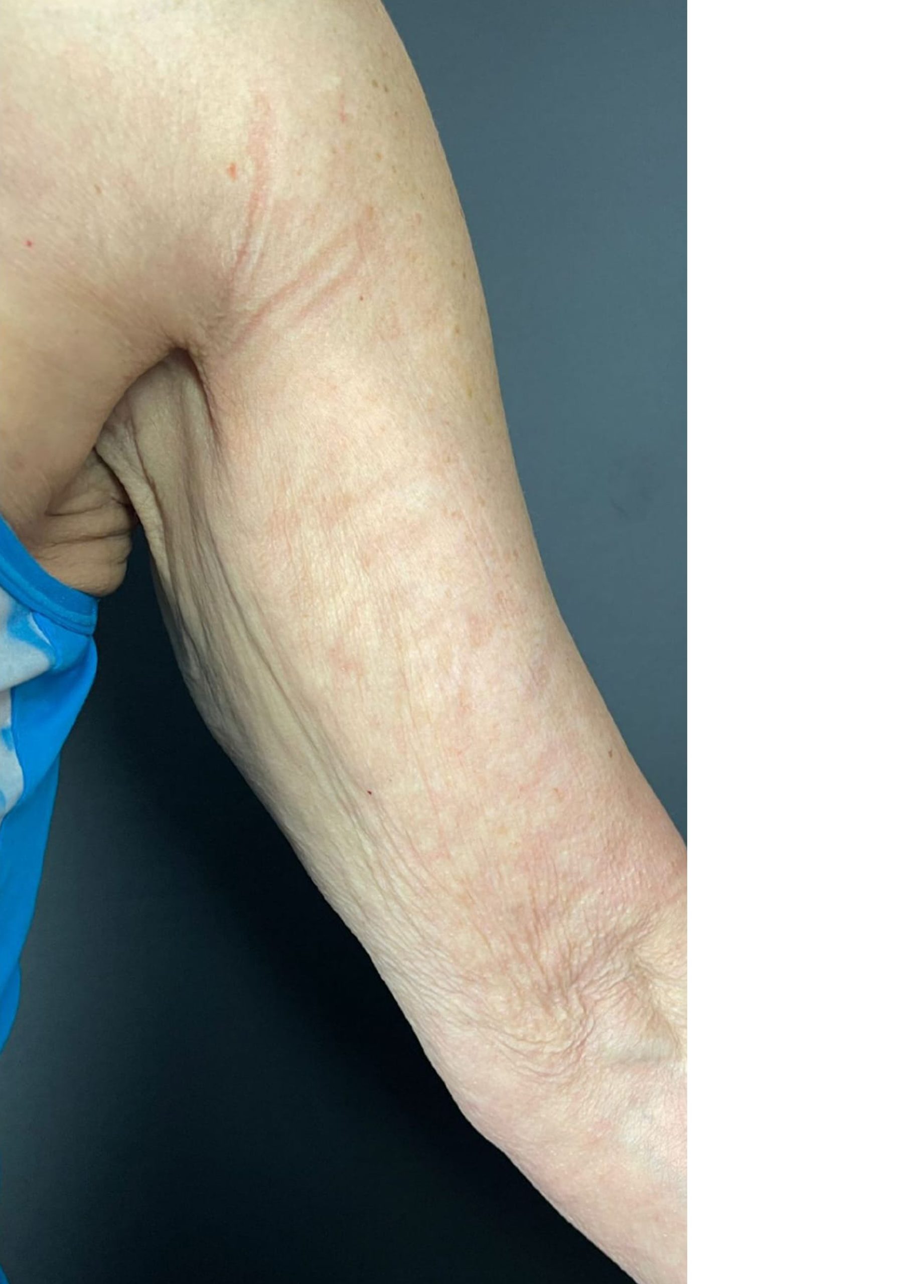 Profhilo Treatment London, Profhilo Body London | Profhilo ...