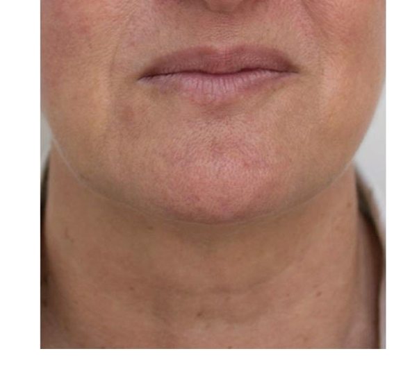 Profhilo Treatment London, Profhilo Body London | Profhilo ...