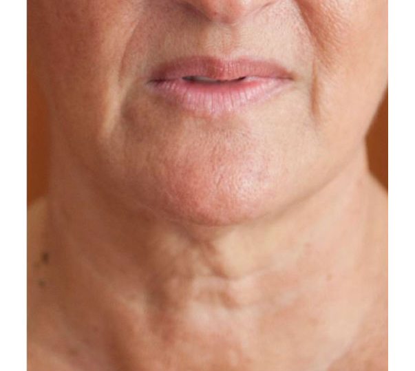 Profhilo Treatment London, Profhilo Body London | Profhilo ...