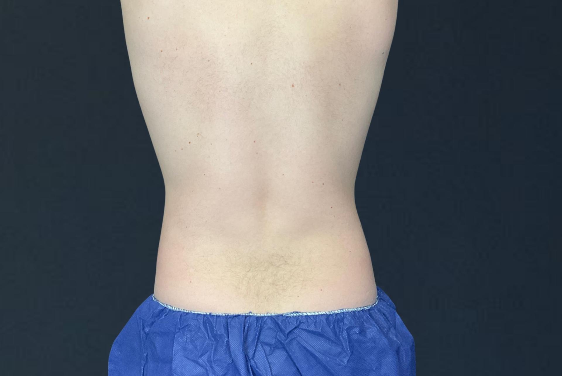 CoolSculpting Fat Freezing near me, London, Buckinghamshire - No1 ...