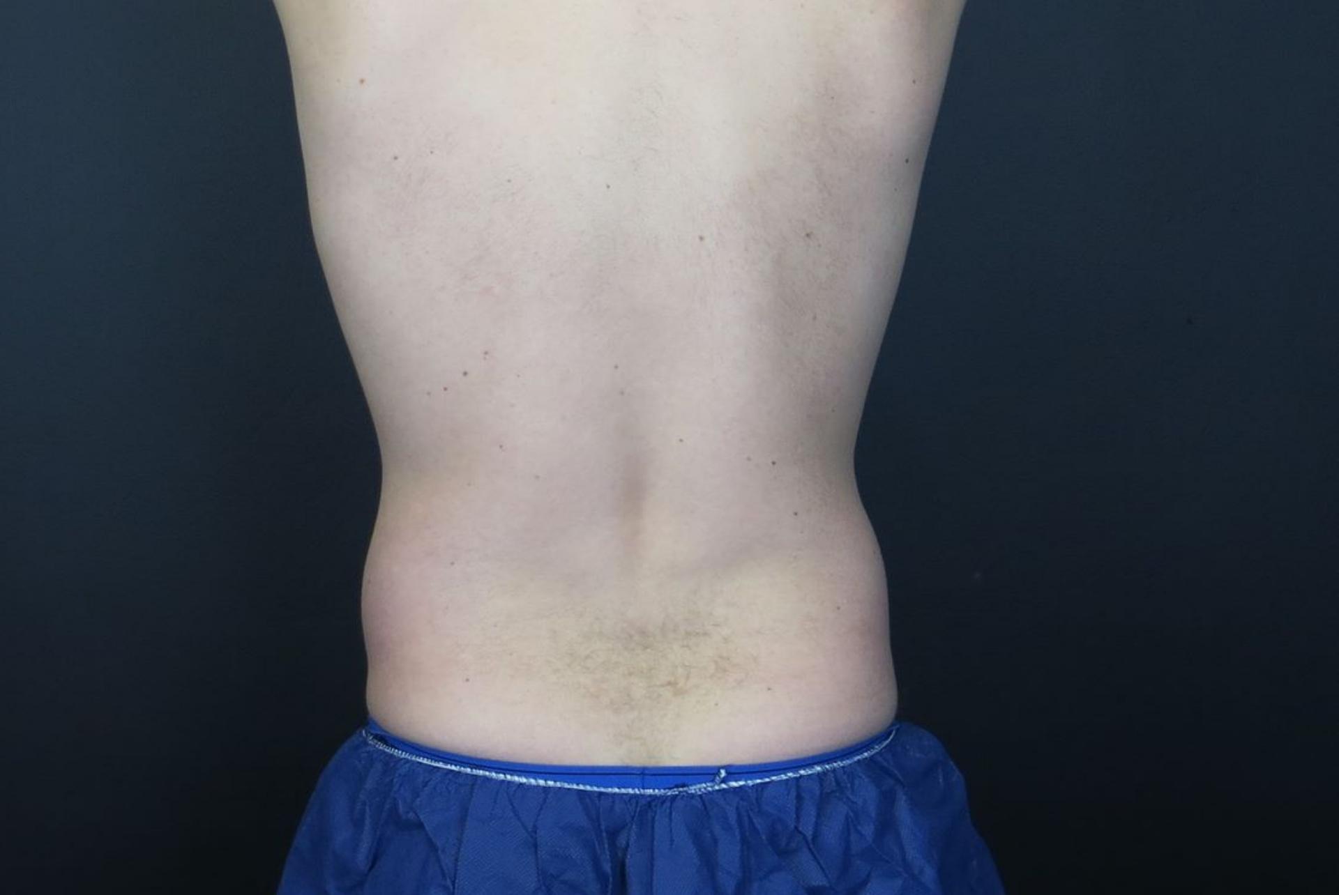 CoolSculpting Fat Freezing near me, London, Buckinghamshire - No1 ...