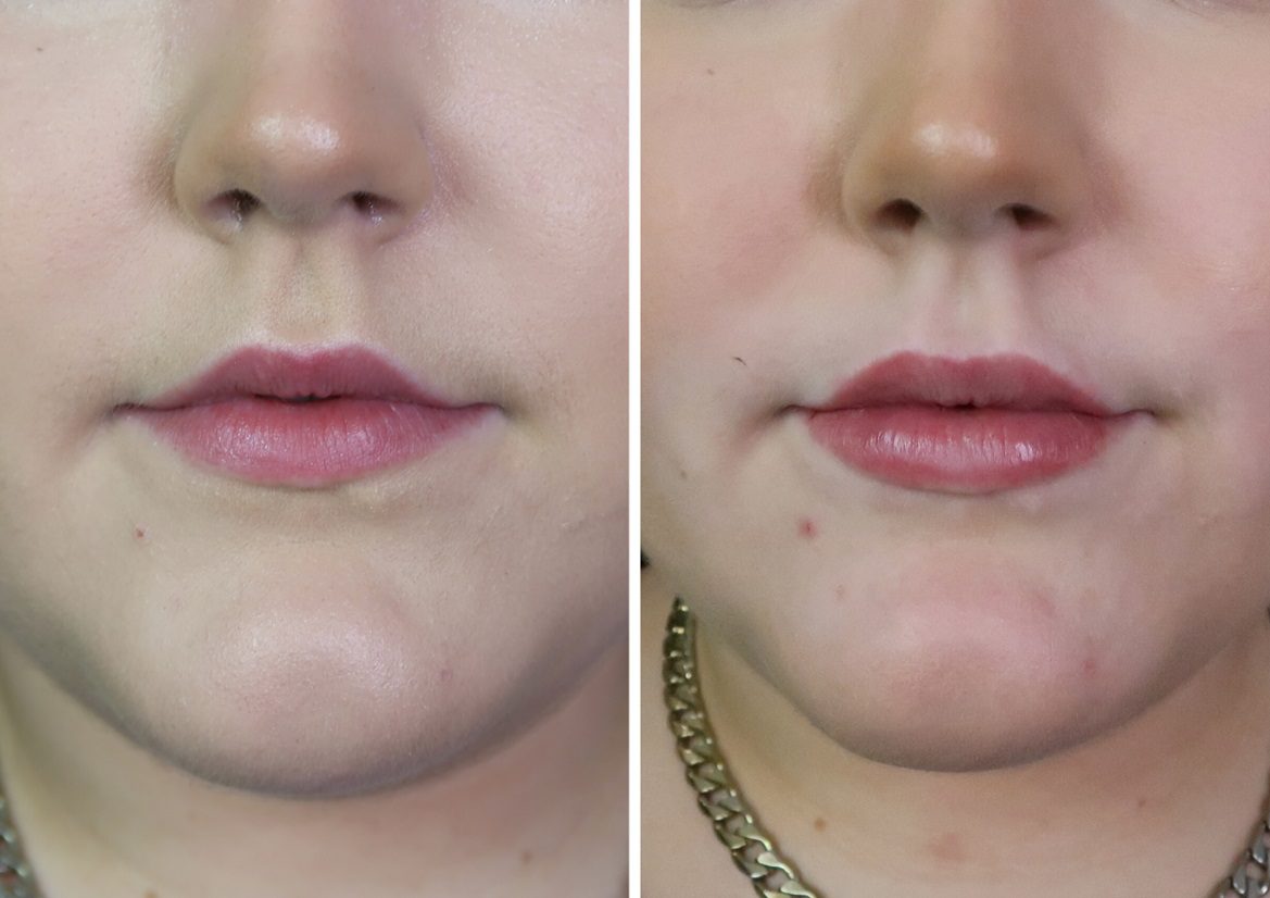 Lip Augmentation with Filler - Natural-looking lip filler before and ...