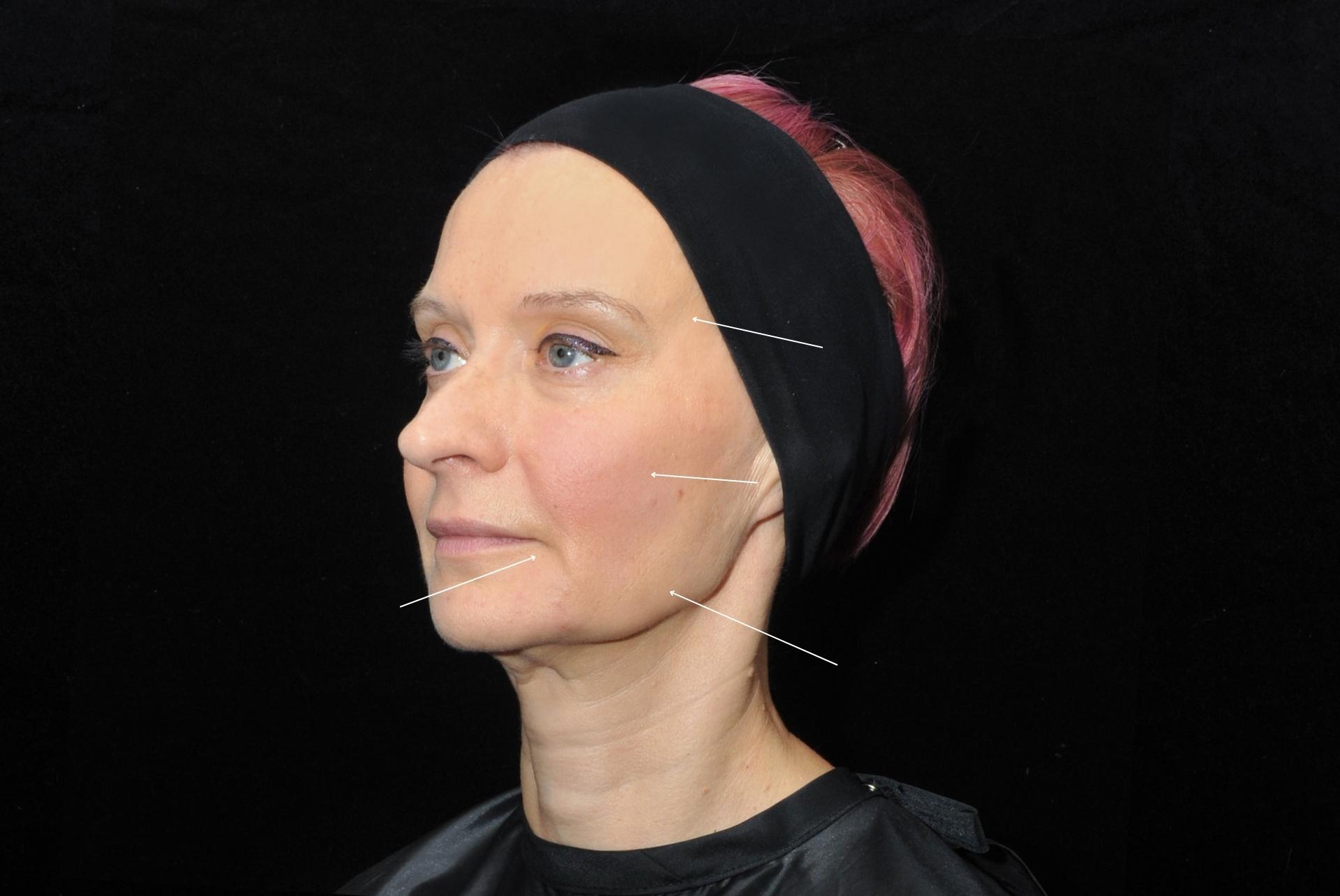 Teoxane | The Cosmetic Skin Clinic