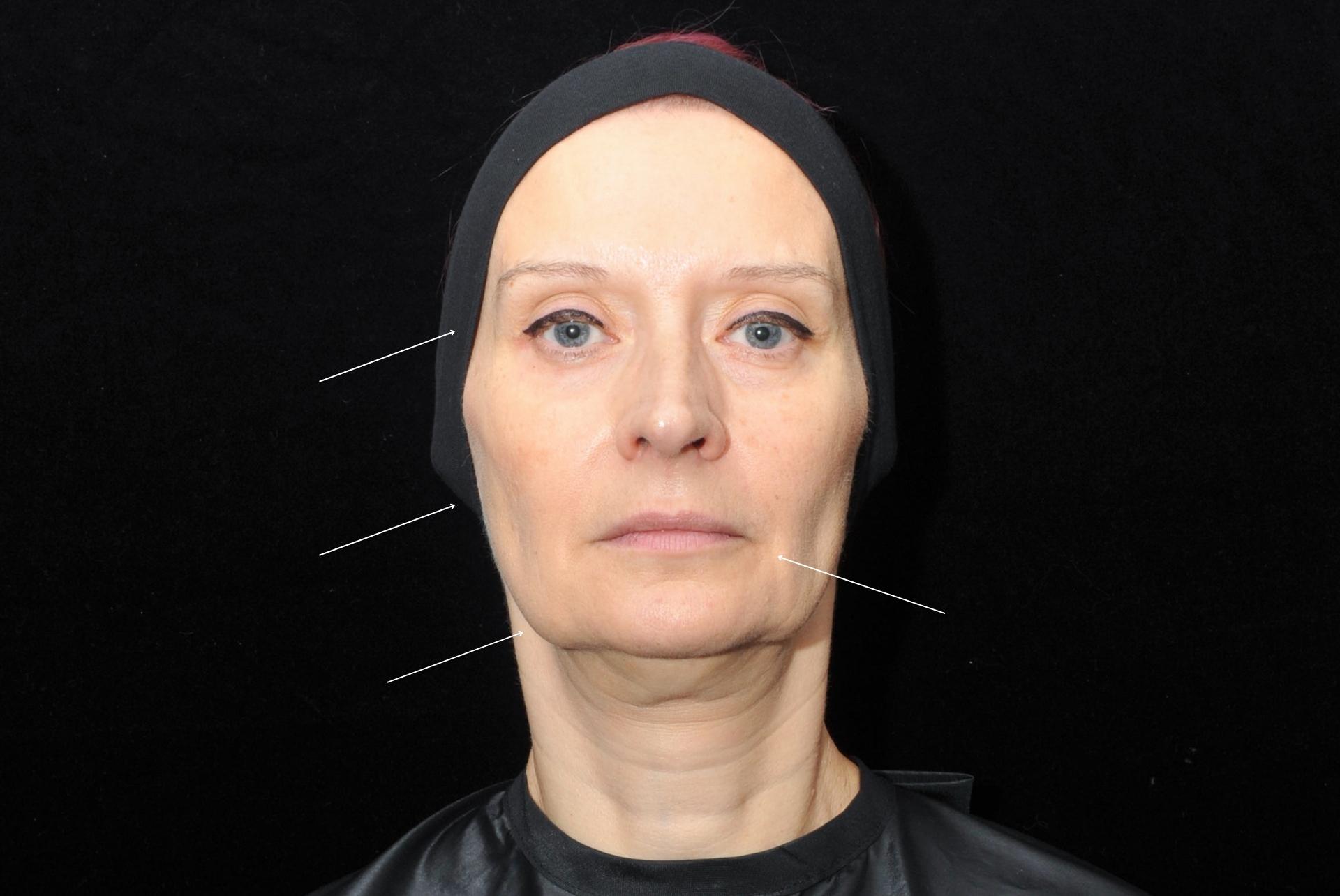 Teoxane | The Cosmetic Skin Clinic