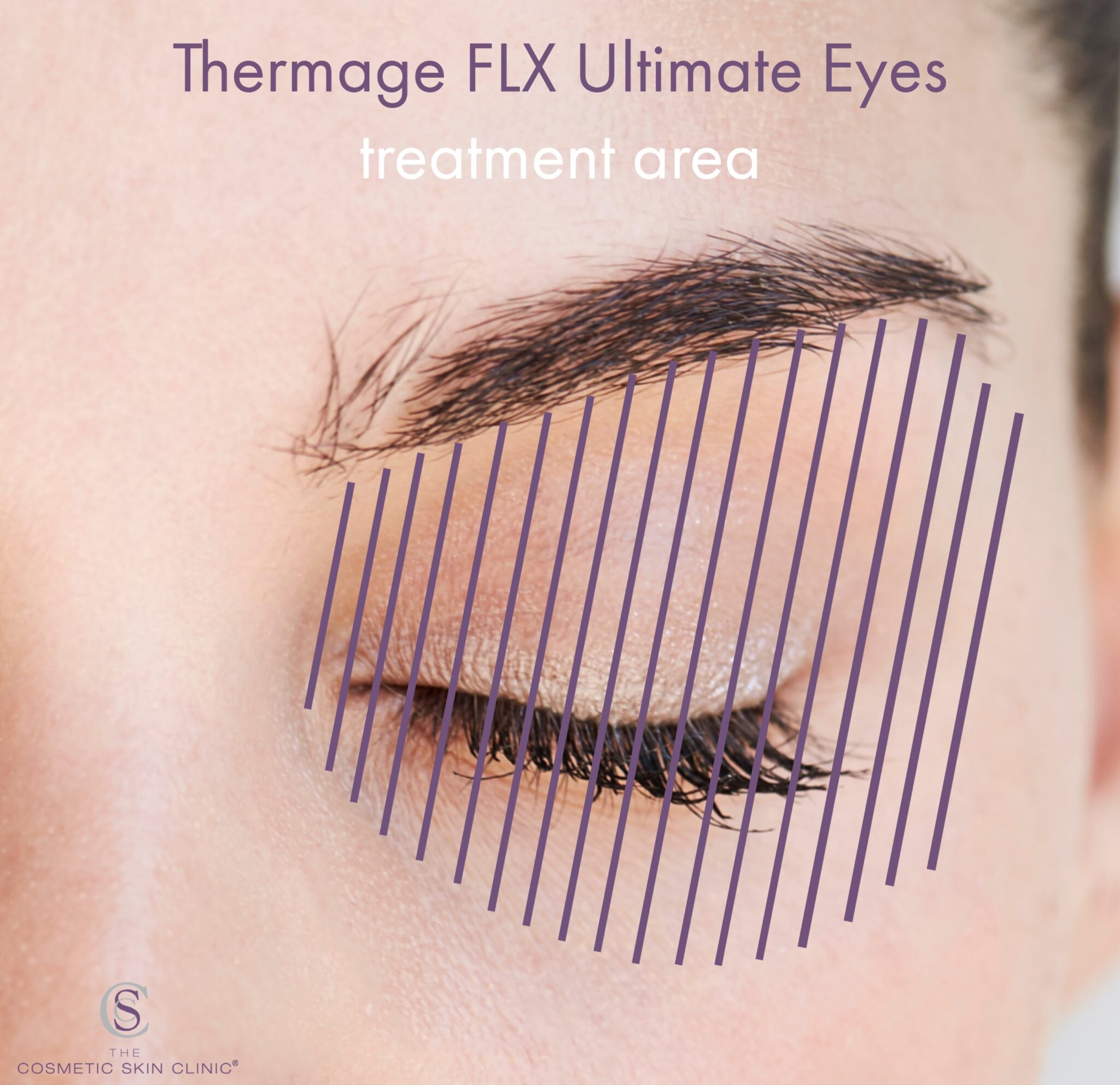 Thermage FLX Non-surgical Eye Lift in London & Buckinghamshire | The ...