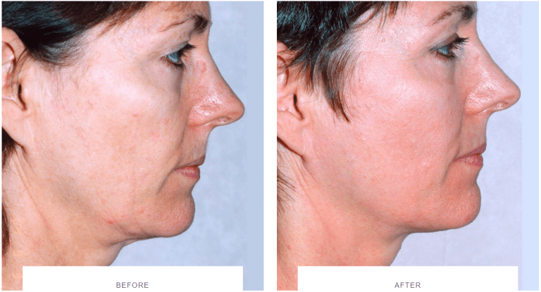 Laser Skin Tightening before and after - Thermage, Morpheus8, Ultherapy ...