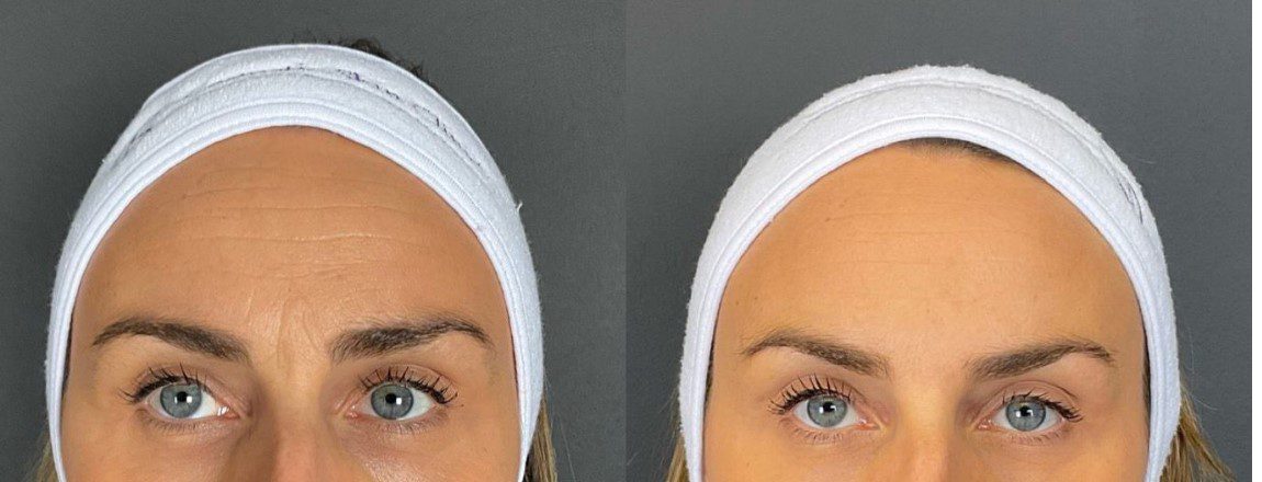 Botox Forehead Before and After: Key Botox injection points and the importance of a qualified ...