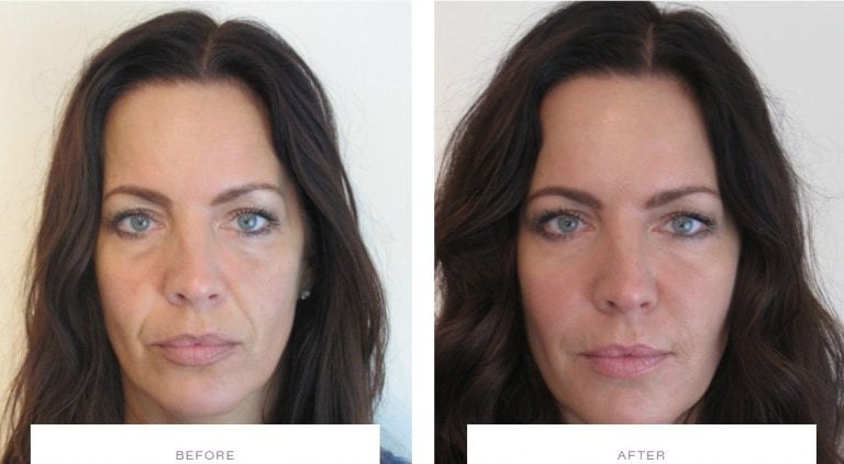 BOTOX® Aftercare FAQs | Botox Aftercare Instructions | Post Botox ...