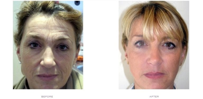 How to get a Cheek Lift with Fillers | Non surgical Cheek Lift, Cheek ...