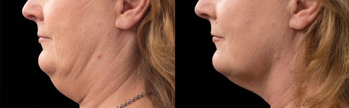 CoolSculpting Mini | The Cosmetic Skin Clinic
