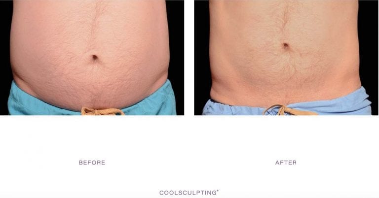 The Benefits of CoolSculpting Treatments for Men | The Cosmetic Skin Clinic