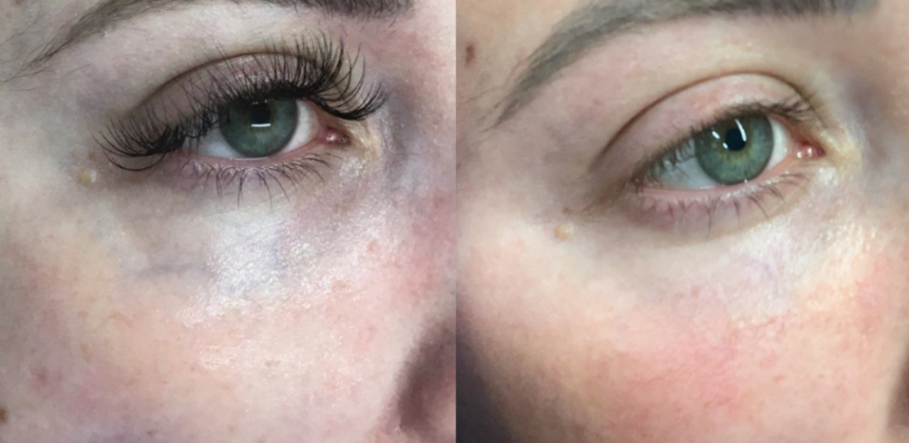 Eye Rejuvenation Case Study | Brighter, Refreshed Eyes - The Cosmetic ...