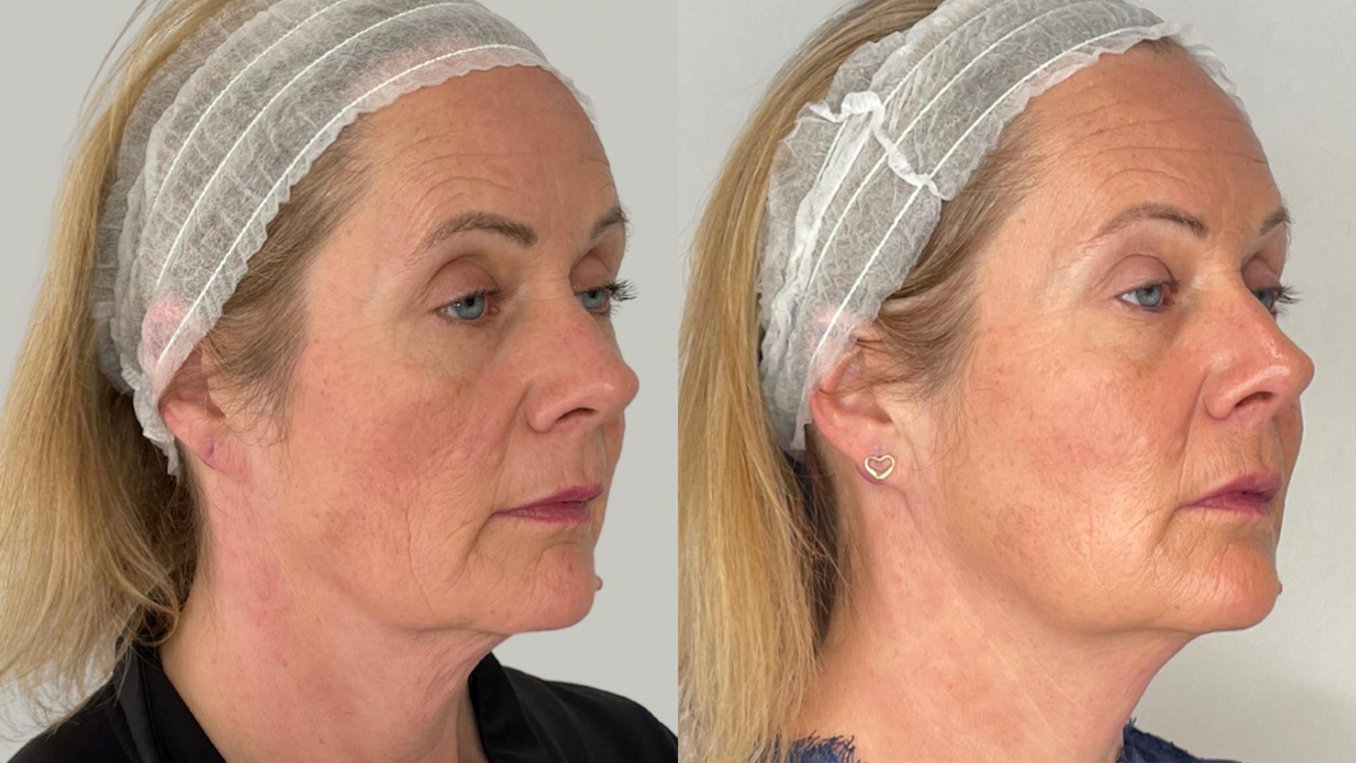 Fillers Before and After | The Cosmetic Skin Clinic Fillers Before and After | The Cosmetic Skin Clinic