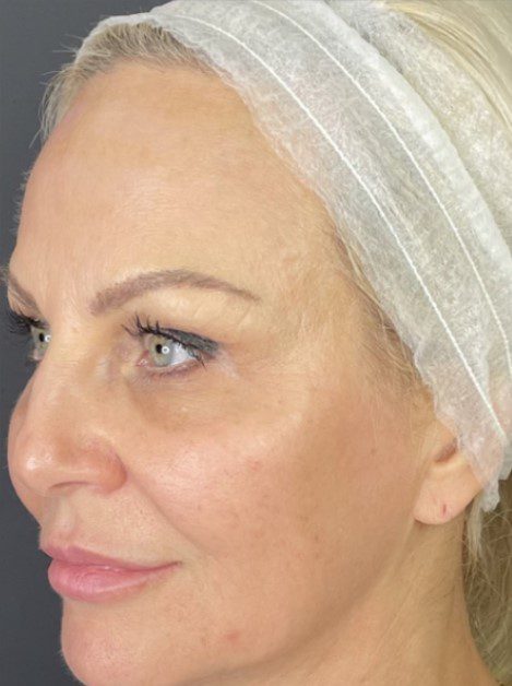Forever Young BBL Before and Afters | Laser Skin Resurfacing Forever Young BBL Before and Afters | Laser Skin Resurfacing