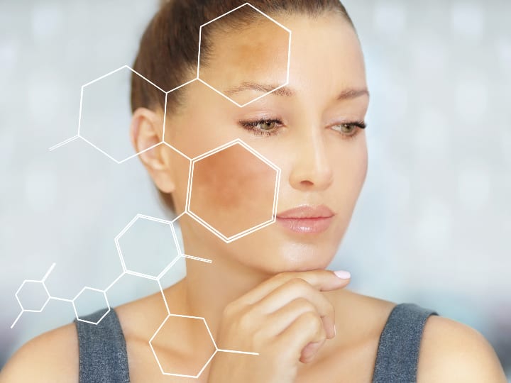 Brown Sun Spots How To Get Rid Of Them! | The Cosmetic Skin Clinic