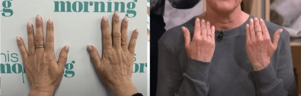 ITV This Morning: Hollywood's New Anti-ageing Treatments for Your Hands ...