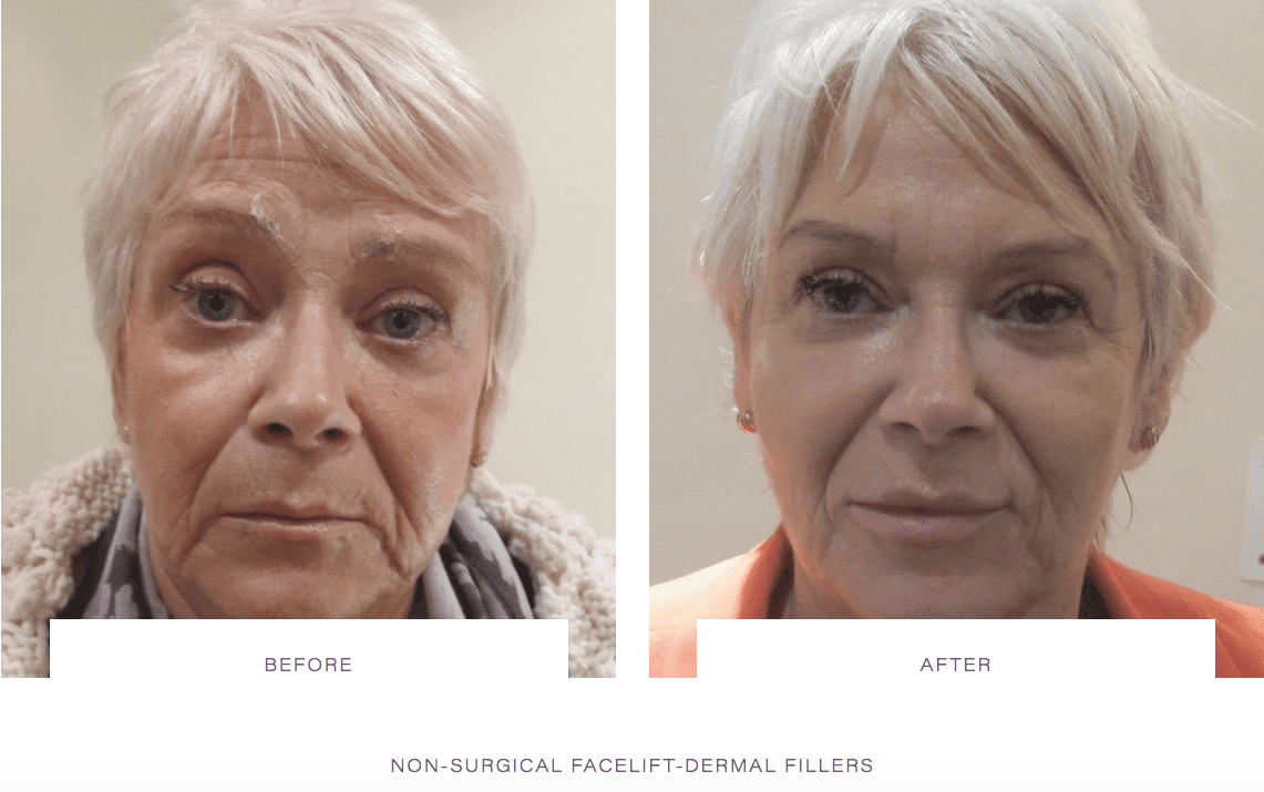 Facelift with Temple Fillers | Non surgical Facelift | The Cosmetic ...
