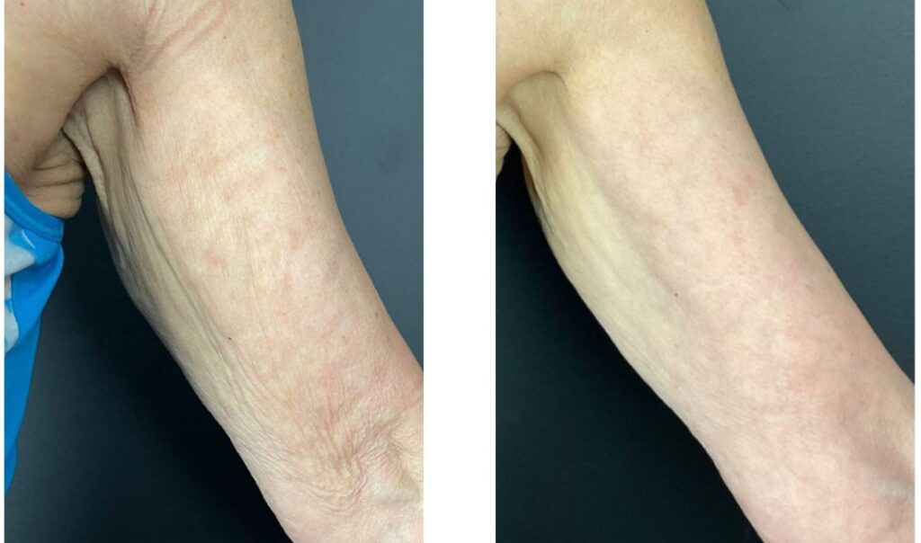 Profhilo Face, Neck, Body in London and Bucks | The Cosmetic Skin Clinic