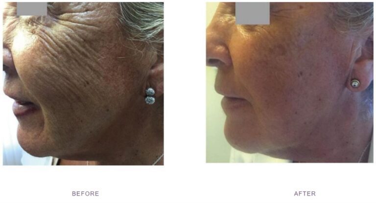 Profhilo Face, Neck, Body in London and Bucks | The Cosmetic Skin Clinic