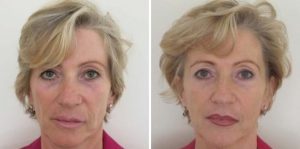Non-Surgical Facelift in London & Buckinghamshire | Facial Aesthetics ...