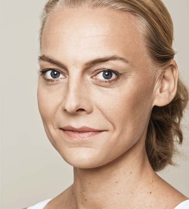 Before & After Tear Trough | The Cosmetic Skin Clinic