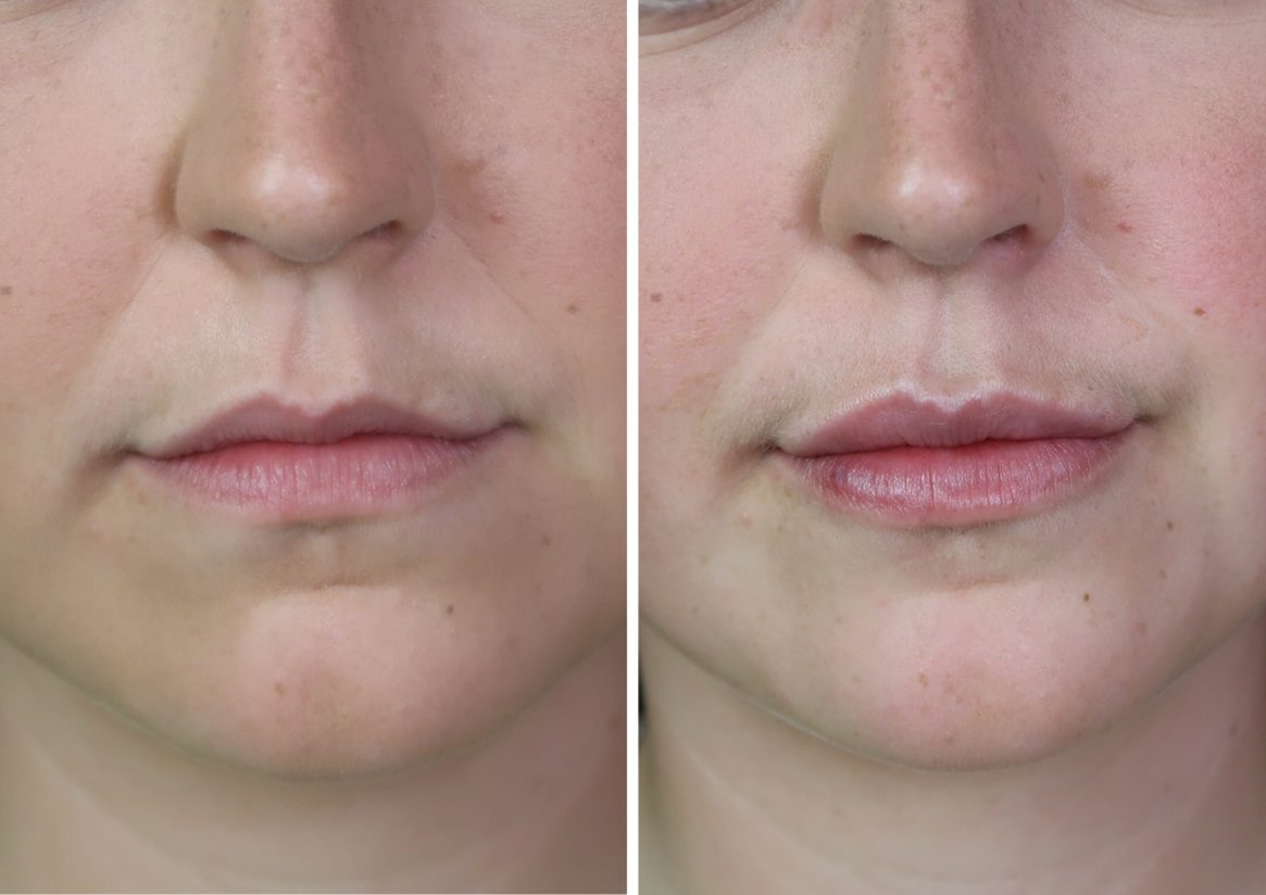 Lip Augmentation with Filler - Natural-looking lip filler before and ...