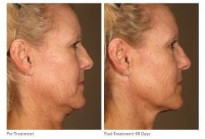 How To Get Rid Of Turkey Neck | Silhouette Soft Thread Lift, Ultherapy ...